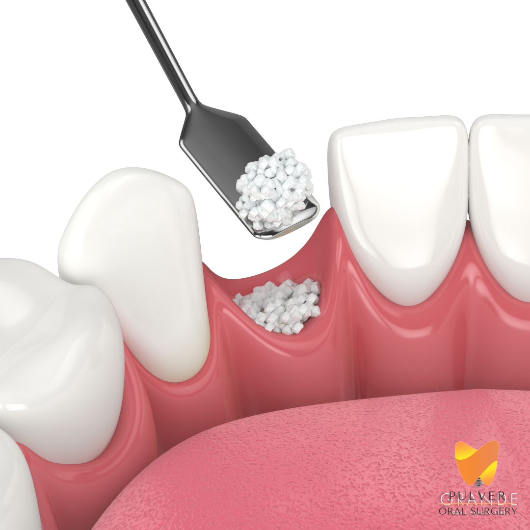 Socket Preservation Highland IN